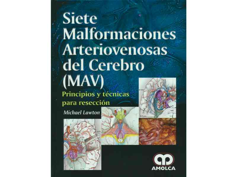 Siete Malformaciones Arteriovenosas del Cerebro (MAV). Principios y ...
