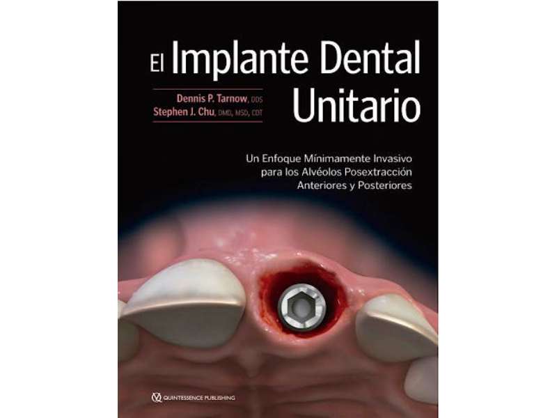 El Implante Dental Unitario. Un Enfoque Mínimamente Invasivo para los ...