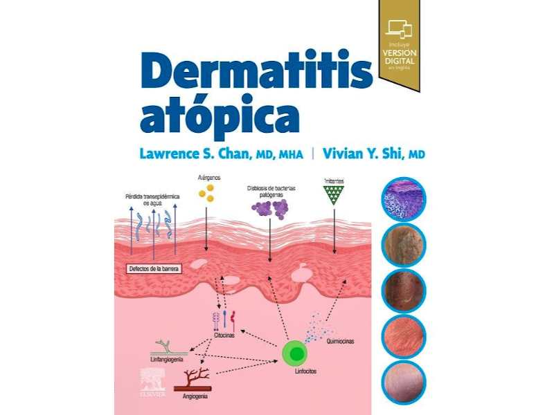 Dermatitis Atópica