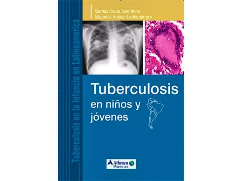 Tuberculosis en Niños y Jóvenes