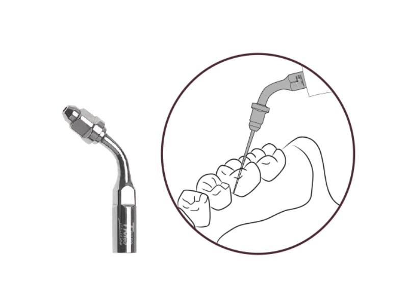 Inserto endo per ablatore, compatibile EMS 120, Woodpecker E1